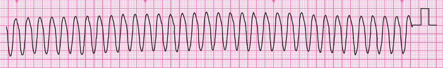 Resuscitation Council (UK) - Advanced Life Support - Interpreting the ECG
