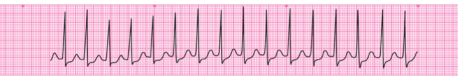 Resuscitation Council (UK) - Advanced Life Support - Interpreting the ECG